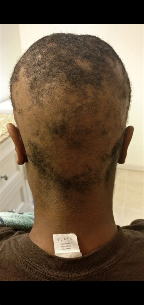 Had A Scalp Biopsy Done And The Diagnosis Was Diffuse Alopecia Areata Not Completely Bald