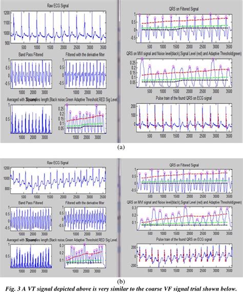 Pdf Detection Of Ventricular Fibrillation And Ventricular Tachycardia