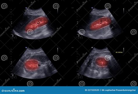 Ultrasound Of Urinary Bladder Or Kub For Screening Renal And Bladder