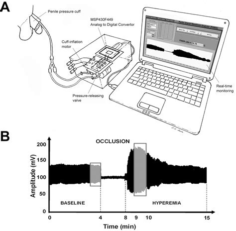 Figure 1 From Penile Arterial Waveform Analyzing System For Early