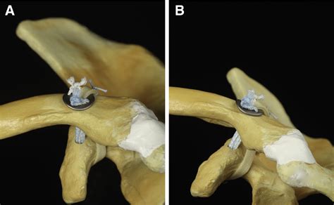 Figure 2 From Arthroscopic Coracoclavicular Ligament Reconstruction Of Chronic Acromioclavicular