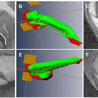 Distance Between PCL Attachments And PCL Surface Length At Flexion Download Scientific