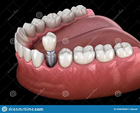 Premolar Tooth Recovery With Implant Medically Accurate 3d
