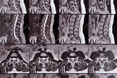 Mri Of A Patient With Intervertebral Disc Protrusion And