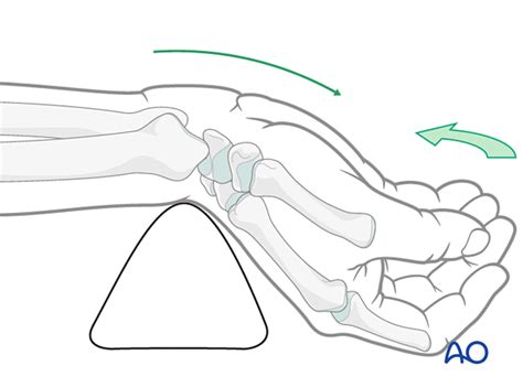 Minimally Invasive Palmar Approach To The Scaphoid