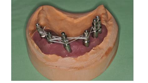 Video How To Make An Implant Verification Jig
