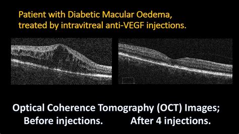 Antivegf Intravitreal Injections Given By Non Medical Healthcare