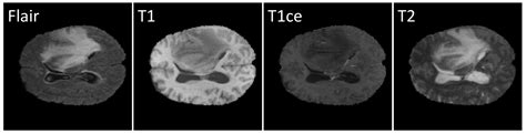 A Multimodal Feature Distillation With Cnn Transformer Network For Brain Tumor Segmentation With