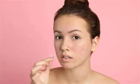How To Remove Pimple Marks Naturals Tips Women Slogans