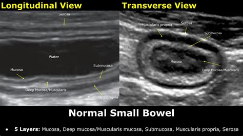Solution Small Bowel Ultrasound Normal Vs Abnormal Image Appearances