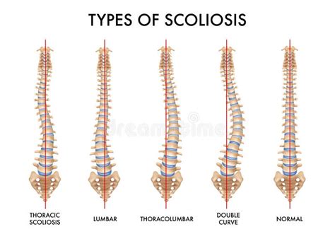 Composición De La Columna Vertebral De Escoliosis Realista Ilustración
