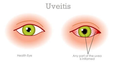 Uveitis Dc Eye Clinic
