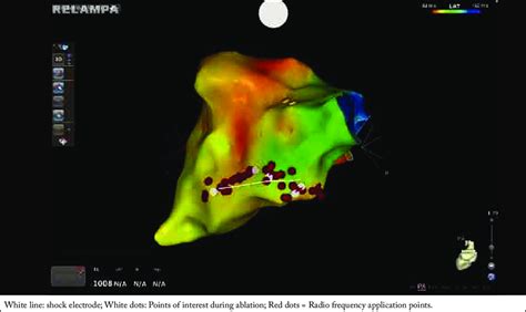 Electroanatomic Mapping In Sinus Rhythm Download Scientific Diagram