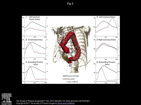 Computational Fluid Dynamics And Aortic Thrombus Formation Following Thoracic Endovascular