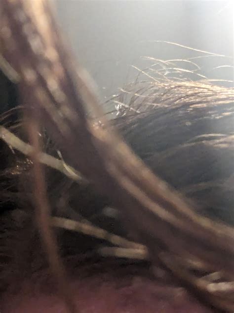 Scabies Hair R Scabies