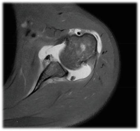 Instability Open Vs Arthroscopic Intechopen