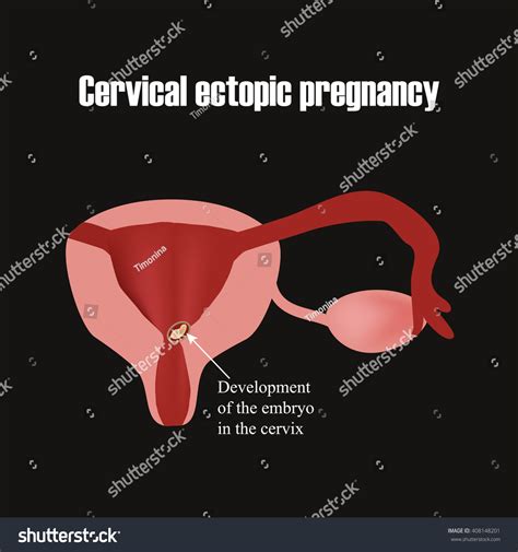 Development Embryo Cervix Ectopic Pregnancy Infographics ภาพประกอบสต็อก 408148201 Shutterstock
