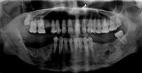 Osteitis Fibrosa Cystica X Ray