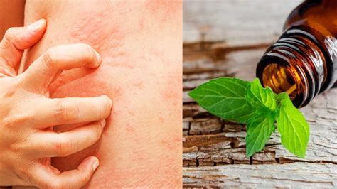 Effective Home Remedies For Itchy Skin Rashes Alldaychemist