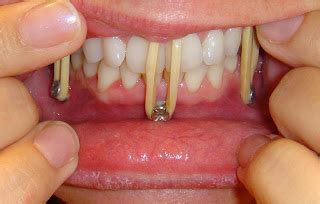 Mouth Wired Shut After Jaw Surgery