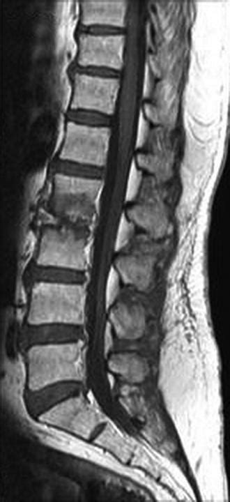 Adult Pyogenic Vertebral Osteomyelitis Spine Orthobullets