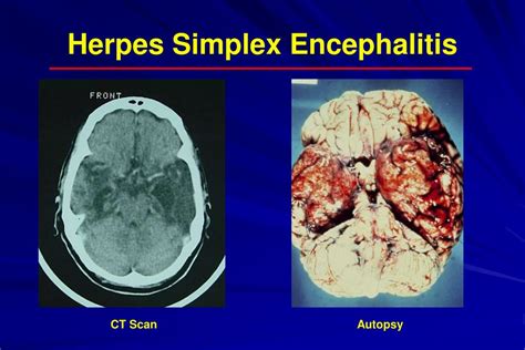 Ppt Herpesviridae 1 Powerpoint Presentation Free Download Id 6775459