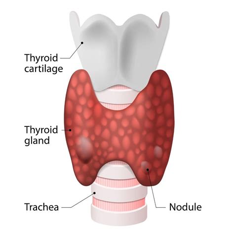 Thyroid Nodules The Metabolic Clinic