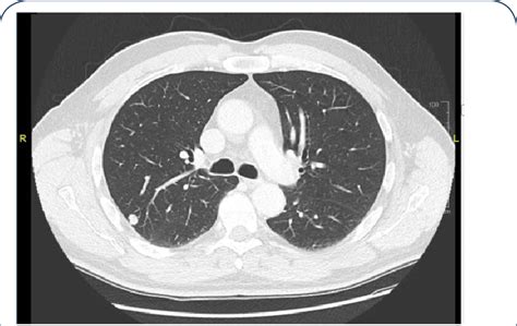 Computed Tomography Scan Showing A Right Pulmonary Nodule Download Scientific Diagram