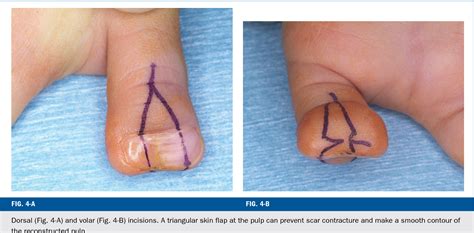 Figure 4 From Modified Bilhaut Cloquet Procedure For Wassel Type Ii And Iii Polydactyly Of The