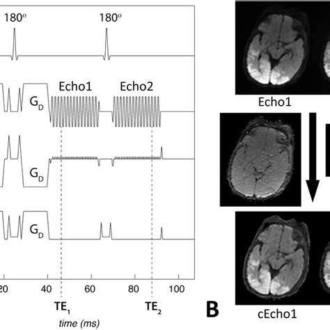 Pdf Intensity Corrected Dual Echo Echo Planar Imaging De Epi For
