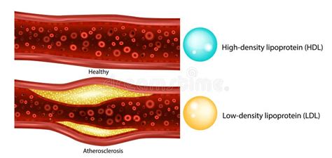 Cholesterol Low Density Lipoprotein Ldl And High Density Lipoprotein Hdl Atherosclerosis