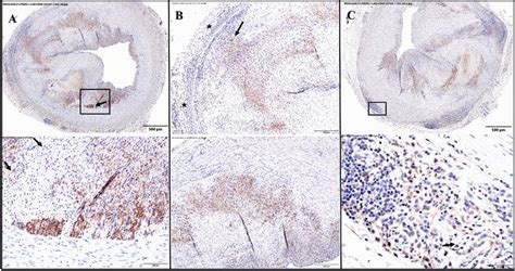 Representative Lesion Lad In The Fh Wms Cd68 And Cd163 1 Ihc Dab And Download Scientific