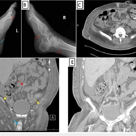 Radiological Findings A And B Left And Right Foot X Rays Showing Download Scientific Diagram
