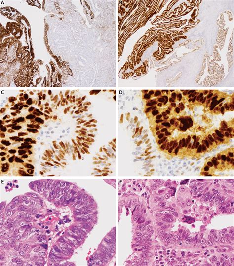 Cases Showing Subclonal P53 Staining Patterns A B Low‐power Images Download Scientific