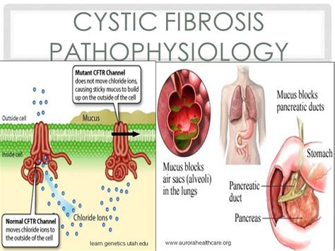 Cystic Fibrosis Lungs Diagram Cystic Fibrosis The Lancet
