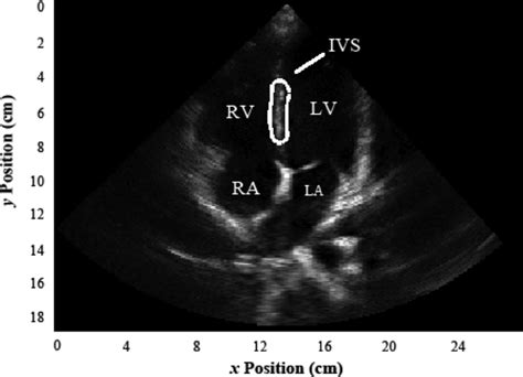 B Mode Frame Obtained From An Apical Four Chamber View Of The Heart
