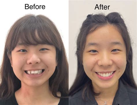 Invisalign Your Smile Our Priority Kl Dental