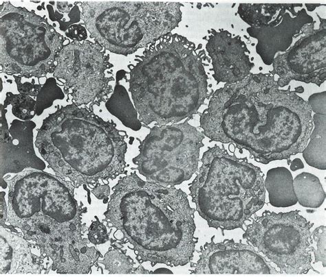 Same Case As Fig 2 After Therapy The Microvilli Are Still Present