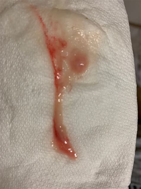 What Is This Start Of Period Implantation Bleeding Miscarriage