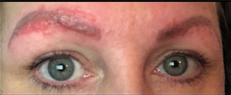 Woman Hospitalized For Infection From Microblading