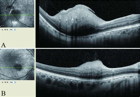 Retinal Astrocytic Hamartoma In Tuberous Sclerosis Complex In An