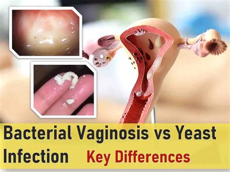 Blood Yeast Infection Complications