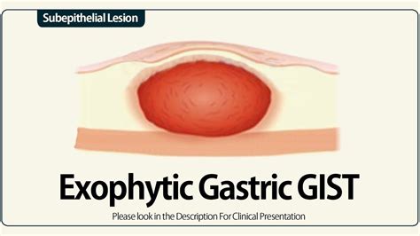 Linear Eus Exophytic Gastric Gist Youtube