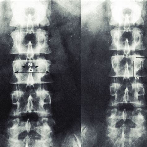 Antero Posterior View Of The Lumbar Segment Of The Vertebral Column