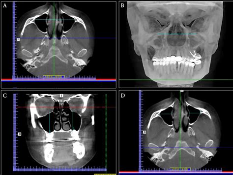 The Relationship Between Optic Nerve And Onodi Cells On Ct Scan European Journal Of Anatomy