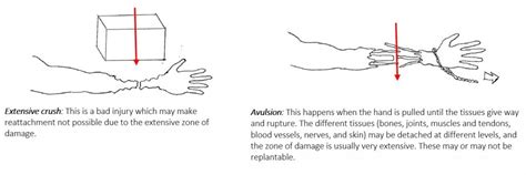 Amputation Of The Hand Bjios Orthopaedics