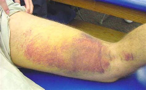 Hamstring Injuries Treatment With Physical Therapy