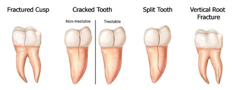 Fractured Cusp Molar