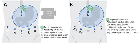 Laparoscopic Surgical Management Of Symptomatic Anastomotic Ulcers