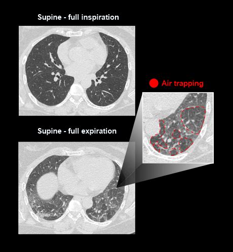 Ct Hrct Chest Hrct